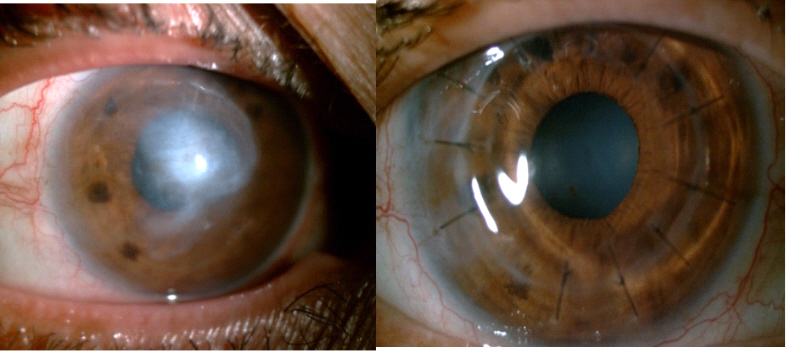 Corneal Transplant Services – Nirmal Eye Institute