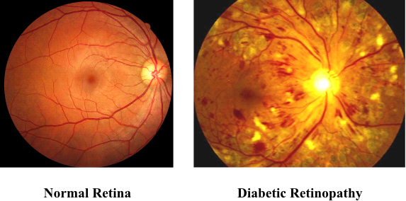 Retina Treatment Services – Nirmal Eye Institute